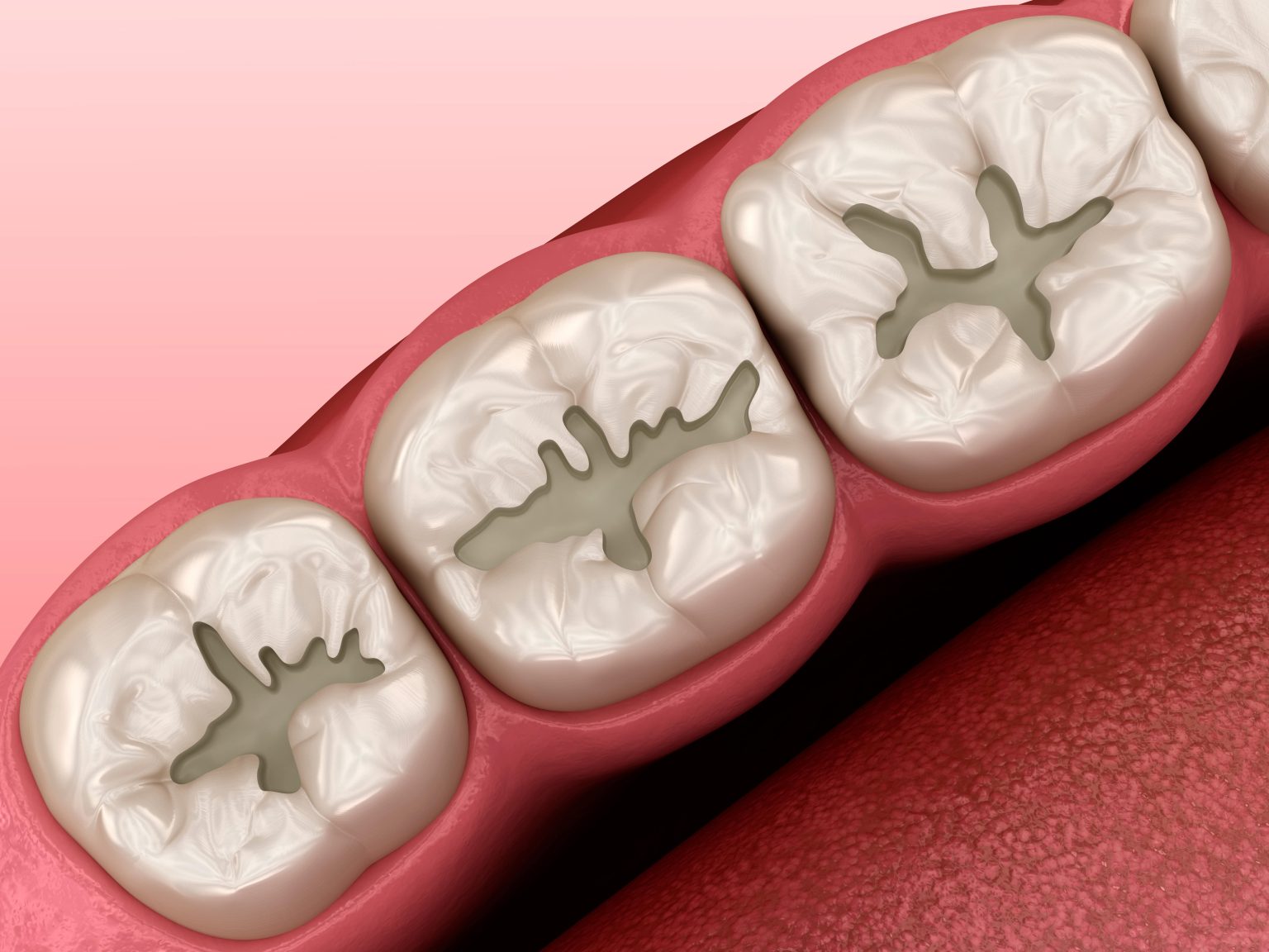 HOW MANY SURFACES IS MY FILLING? | Sacramento Holistic Dentist